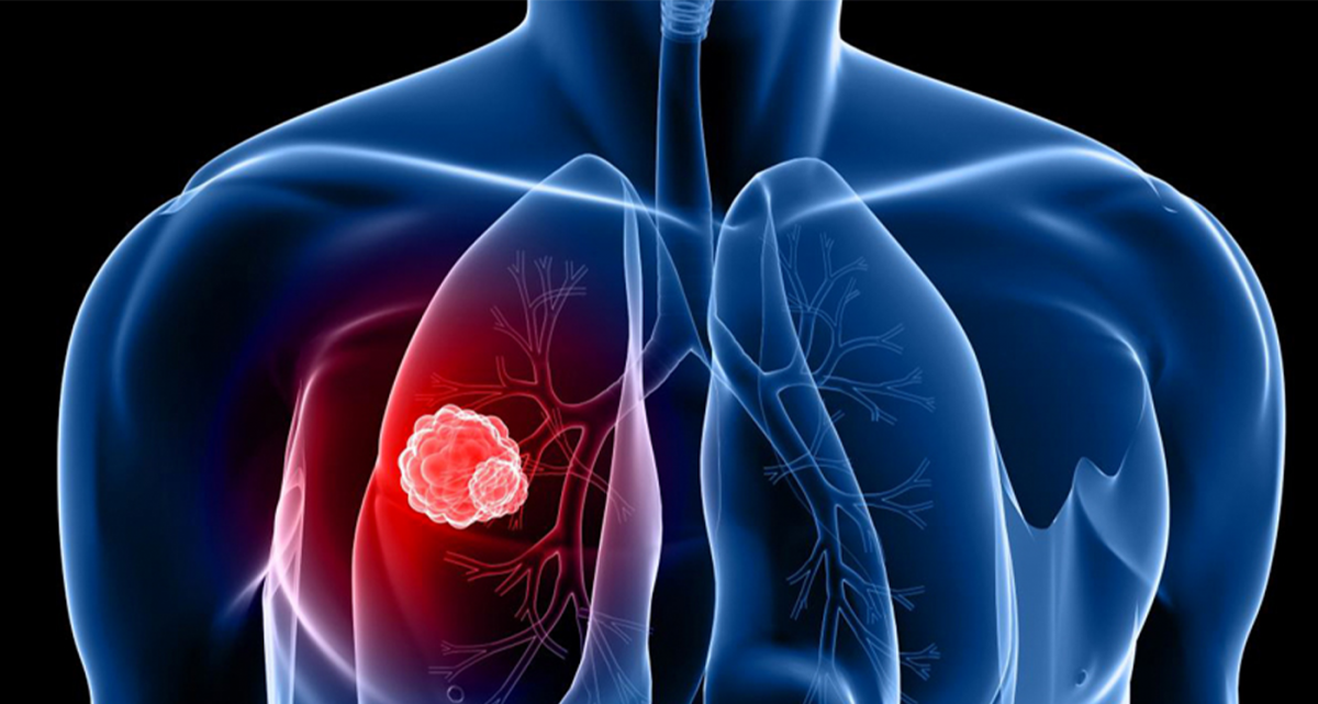 Take radon testing seriously this November for Lung Cancer Awareness ...